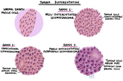 Fnclcc（国家癌症防治中心联合会）我的病理报告