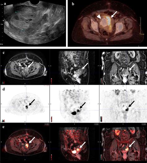 72 Year Old Woman Presenting With Post Menopausal Bleeding Diagnosed Download Scientific