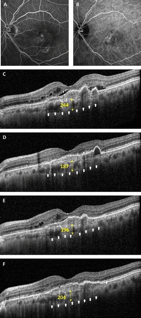 A Representative Case Of A 69 Year Old Male With Polypoidal Choroidal