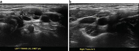 Cervical Lymphadenopathy Ultrasound