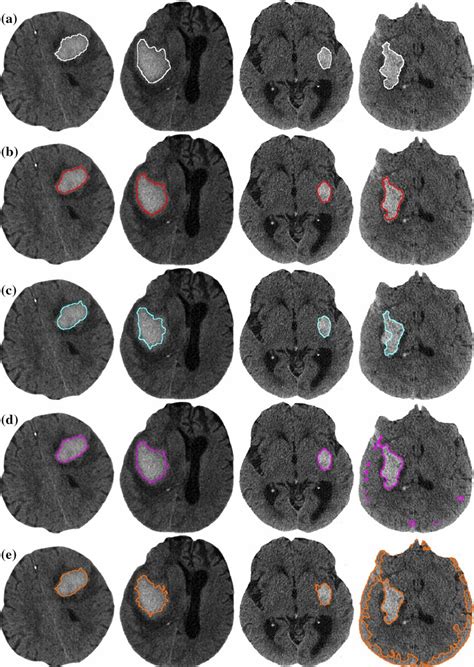 Examples Of Hcv Segmentation Obtained By Automatic Segmentation Methods