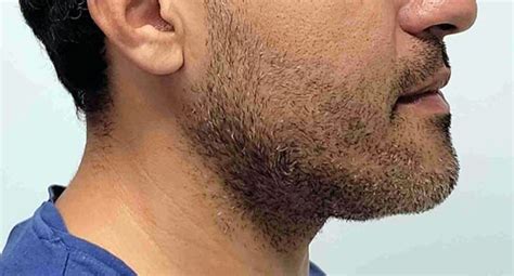 Transform Your Smile Underbite Treatment Before And After Bho