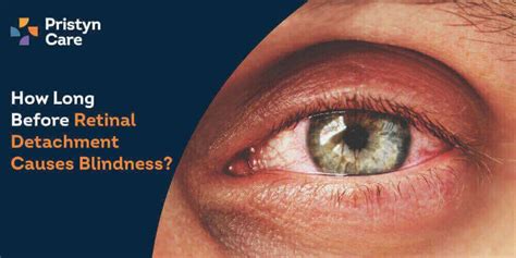 Detached Retina Vision