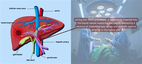 Transarterial Chemoembolization Tace