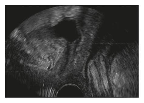 Ultrasound Imaging Of Pelvic Floor Under Various Algorithms A Scb