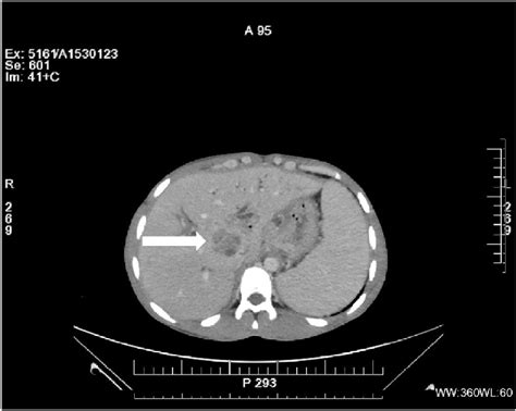 Ipodense Hepatic Focal Lesion In The I • Segment Measuring 4 × 3 Cm Download Scientific