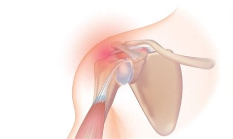 Multidirectional Shoulder Instability Bangalore Shoulder Institute