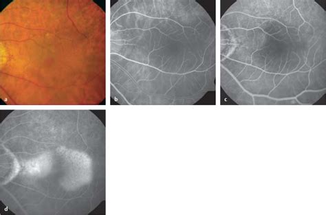 Age Related Macular Degeneration And Choroidal Neovascularization Of Other Etiologies Ento Key