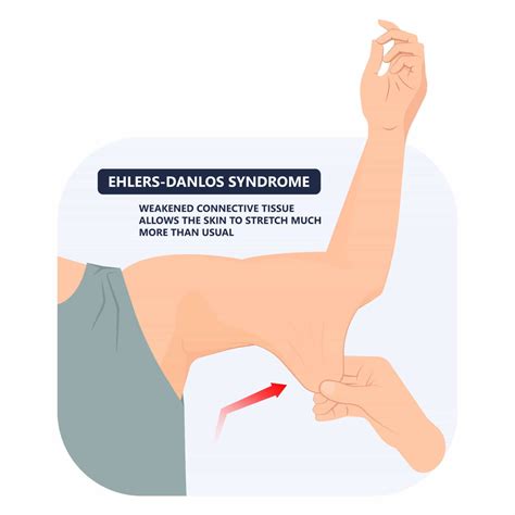 Understanding Ehlers Danlos Syndromes