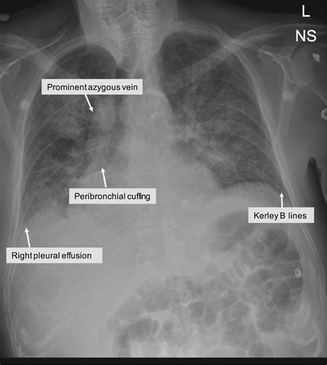 Assessment Of Pulmonary Edema Principles And Practice Journal Of