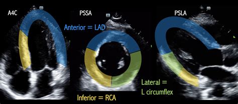 Intern Ultrasound Of The Month Pocus And Regional Wall Motion
