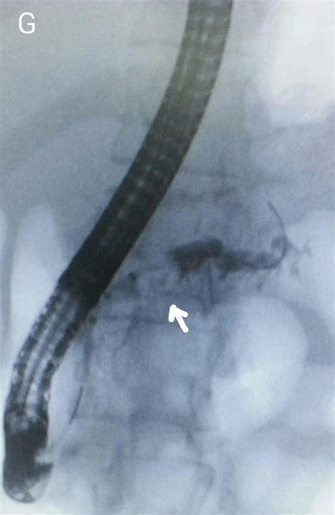 Ercp And Egd March 2014
