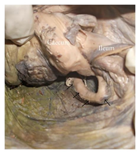 Position Of The Appendix Arrow A Retrocecal Appendix Note The Download Scientific Diagram