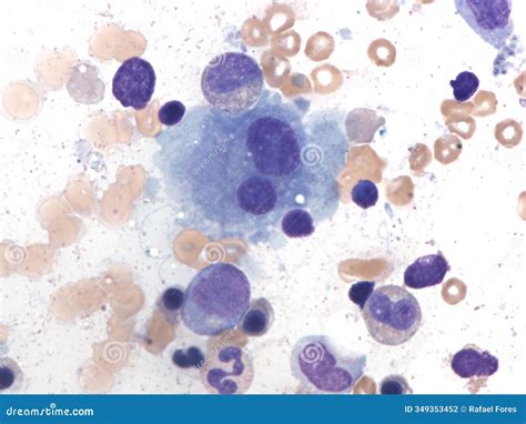 Binucleated Plasma Cell Multiple Myeloma Stock Illustration Illustration Of Myeloma