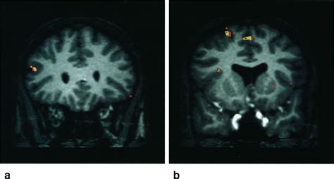 Figure 2 From Functional Neuroanatomy Of Spatial Working Memory In