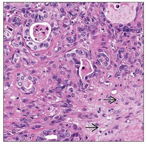 Carcinoma Ex Pleomorphic Adenoma Basicmedical Key