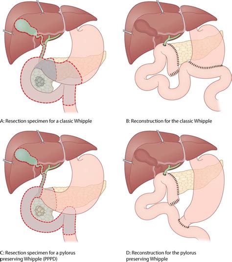 Classic Versus Pylorus Preserving Pancreaticoduodenectomy Download Scientific Diagram