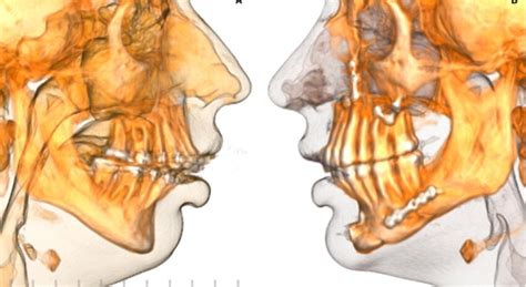 A Dentofacial Deformity With An Angle Class Ii Vertical Maxillary Download Scientific Diagram