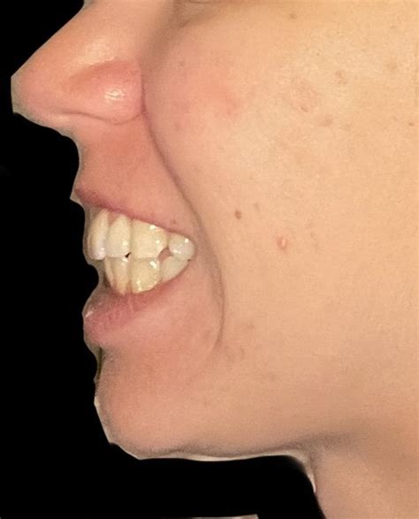 Help What Is Wrong With My Teethbite Rorthodontics