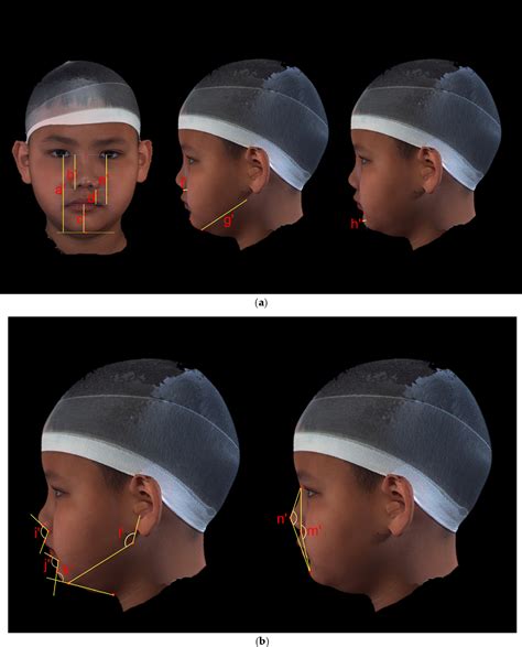 Figure 1 From Occlusion Based Three Dimensional Craniofacial Anthropometric And Symmetric