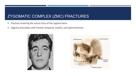 Nasal Bone Fractures Pptx
