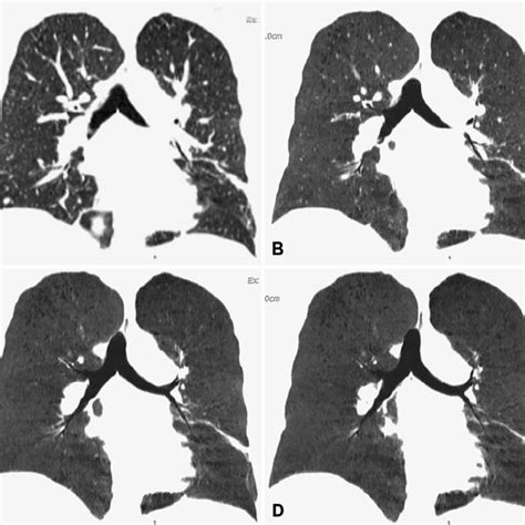 Paraseptal Emphysema Transverse Ct Section Through The Upper Lobes