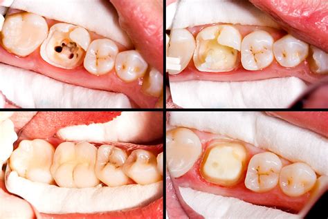 Root Canal Molar Before And After