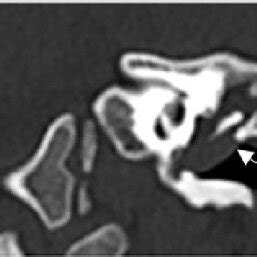 Temporal Bone CT Scan With A Coronal And B Axial Reconstructions Download Scientific