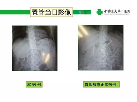 一例重型颅脑损伤合并骨筋膜室综合症的营养治疗丨颅脑创伤 神经重症病例周刊第34期 脑医汇