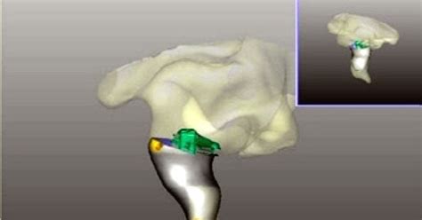 맞춤형 보청기 등 3d프린터 의료분야 적용