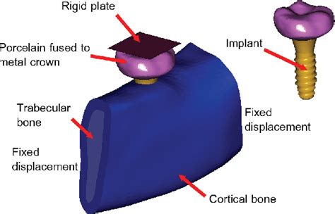 Figure 1 From Simulation Of An Occlusal Interference Of An Implant Crown Semantic Scholar