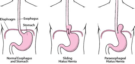 Hiatus Hiatal Hernia Gastroenterology Msd Manual Professional Edition