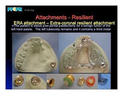 What Are Era Attachments At Bethany Lindrum Blog