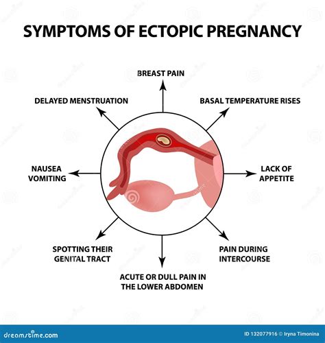 Ectopic Pregnancy Types Of Extra Uterine Pregnancy Is Interstitial