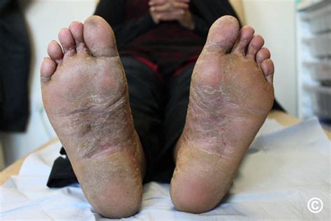 Contact Allergic Dermatitis