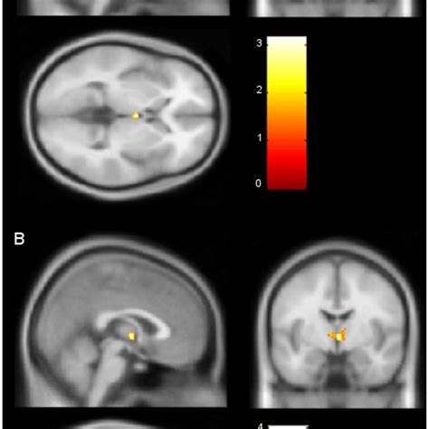 Sex Differences In Hypothalamus Activation A Hypothalamus Activation