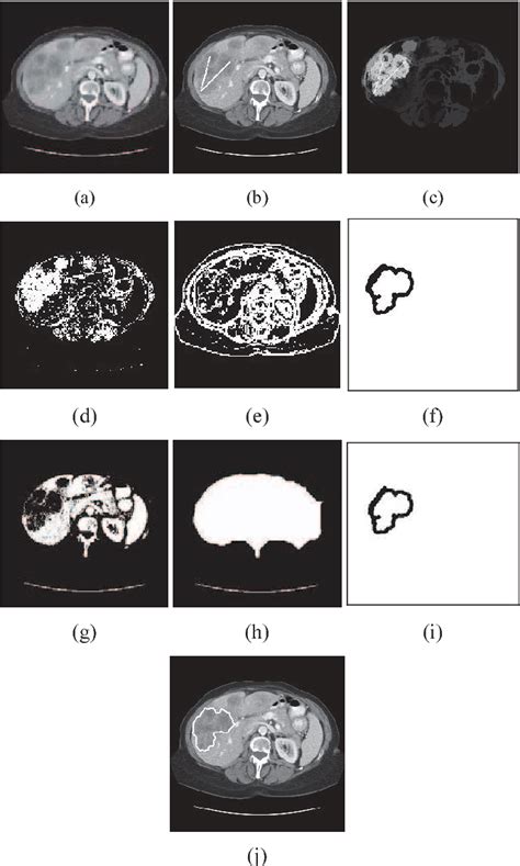 Figure 1 From Segmentation Of Liver Metastasis On Ct Images Using The Marker Controlled