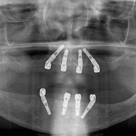 Implance En Aggressor Clinical Case By Dr Marjan Stojanovski