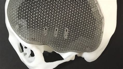 What Is Titanium Mesh Cranioplasty At Irene Rayburn Blog