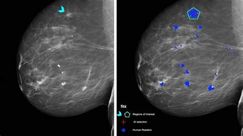 Breast Cancer Mammogram