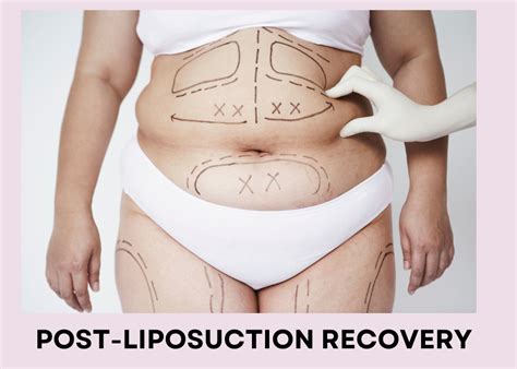 Essential Tips For Post Liposuction Unveiling The Enigma Of Biobond 3