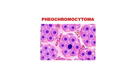Pheochromocytoma Pathology Pathology Made Simple