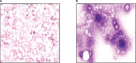 Acute Bone Marrow Necrosis Led To Death A Peripheral Blood Smear