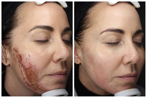 Aesthetics Journal Expert Article Managing Chemical Peel