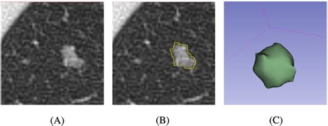 Schematic Processes Of The Nodule Segmentation A Original Ct Image Download Scientific