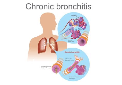 Chronic Bronchitis