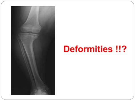 Physiological And Pathological Tibia Vara Ppt Death Injury Or