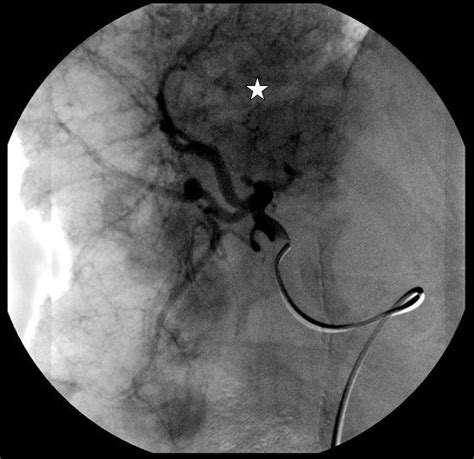 Selective Proper Hepatic Angiogram Demonstrates Hypervascular Download Scientific Diagram