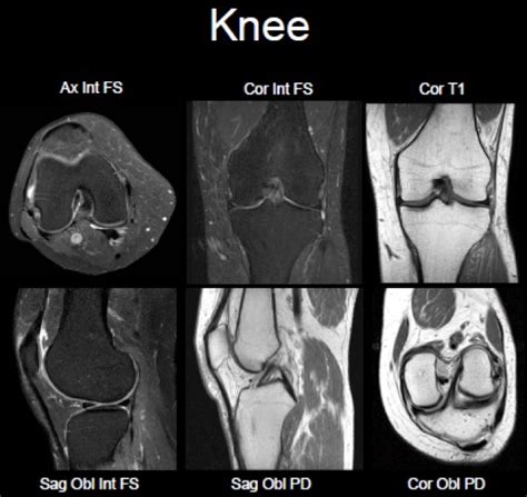 Mri Knee