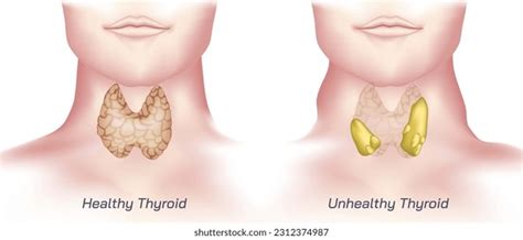Hypothyroidism Vs Hyperthyroidism Healthy Unhealthy Thyroid Stock Vector Royalty Free